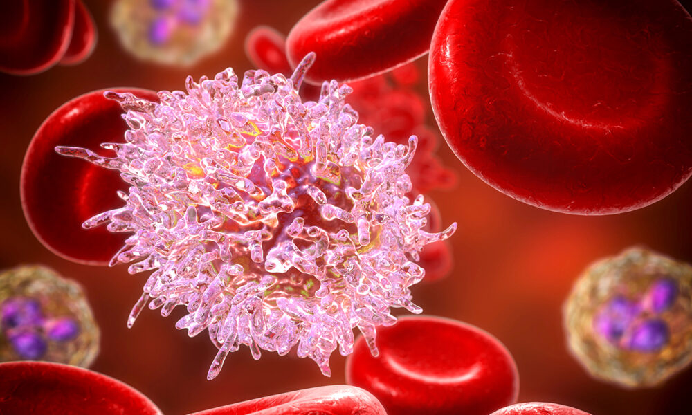 Leucemie: Simptome, cauze, diagnostic și tratament