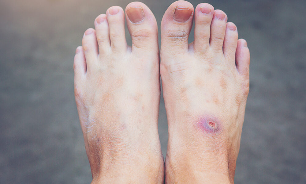 Piciorul diabetic: Cauze, simptome, diagnostic și tratament